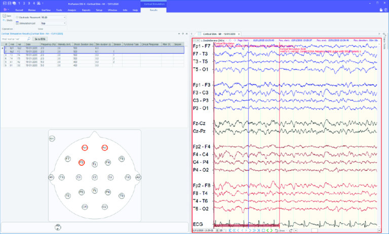 Profusion EEG Software – Compumedics