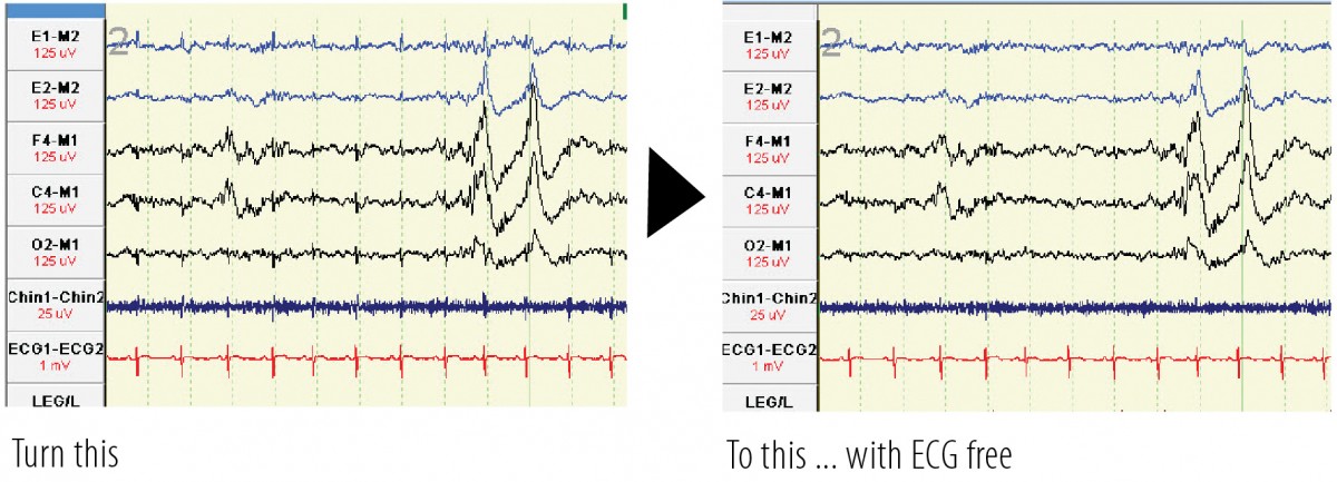 Profusion Plus – Compumedics