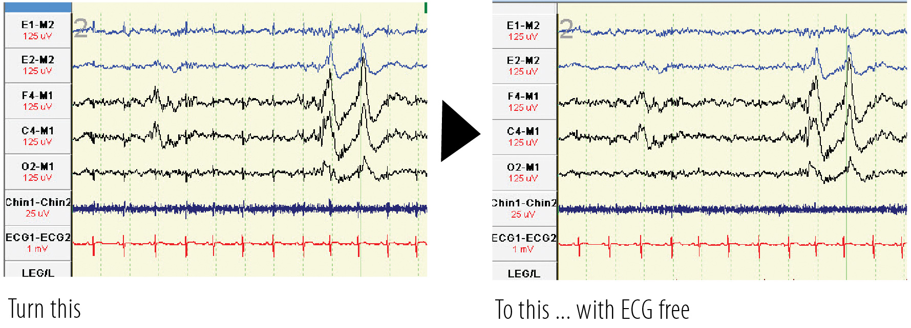 Profusion Plus – Compumedics