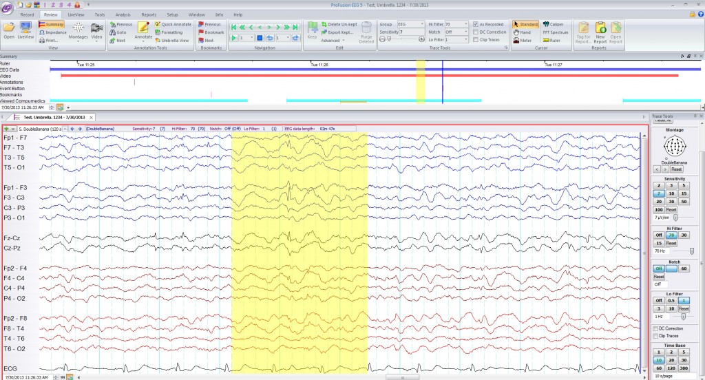 Profusion EEG Software – Compumedics