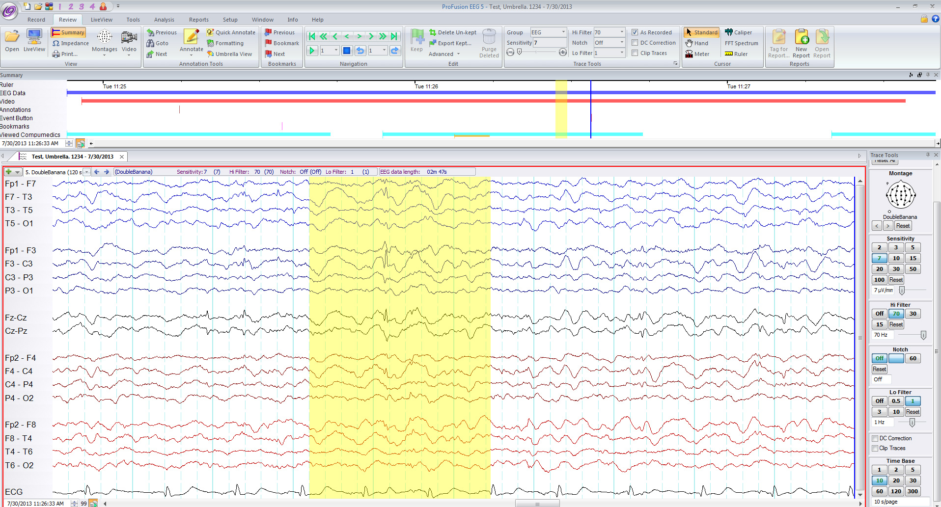 Logiciel Profusion EEG – Compumedics