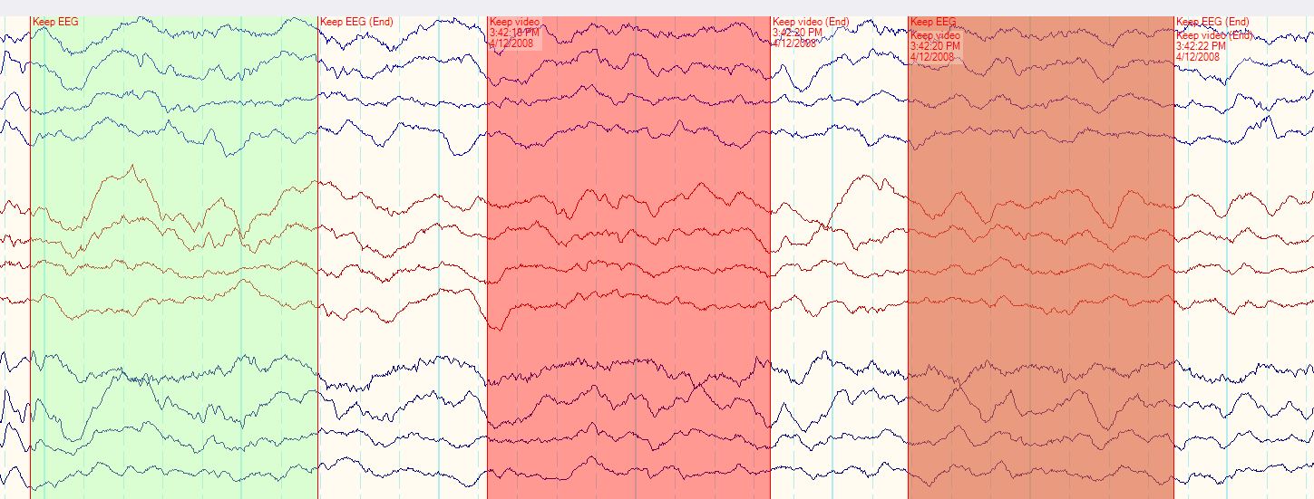Profusion EEG Software – Compumedics