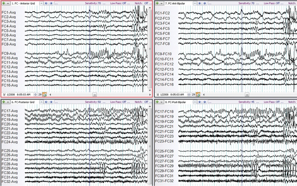 Profusion EEG Software – Compumedics