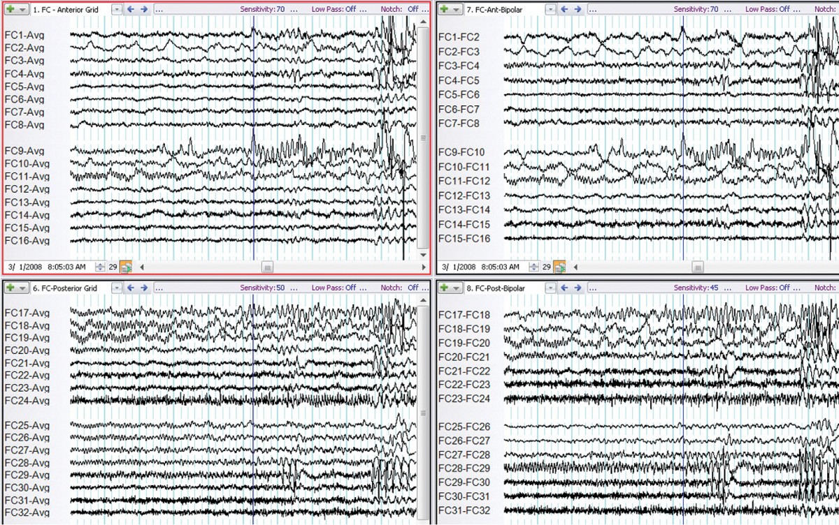 Profusion EEG Software – Compumedics