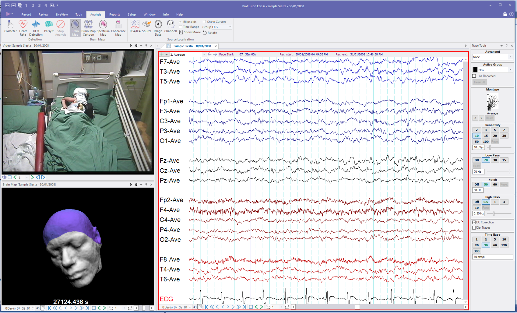 Profusion EEG Software – Compumedics
