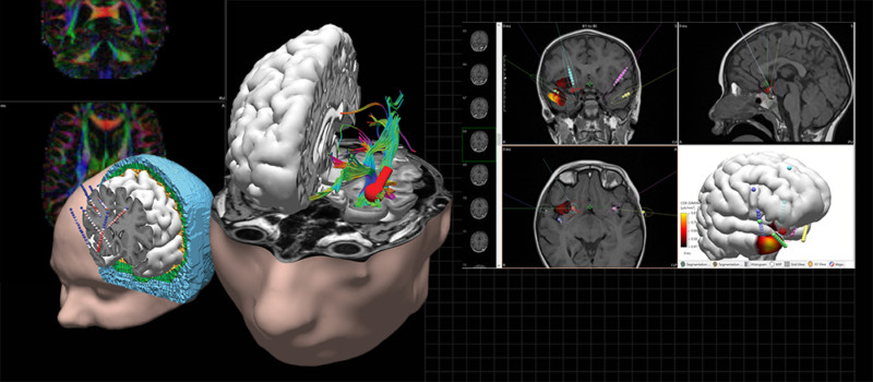 Compumedics Neuroscan Clinical CURRY Workshop: Source Localization in ...